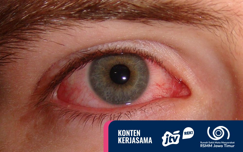 Mata Merah Berulang, Kapan Curiga Alergi? - Portal JTV