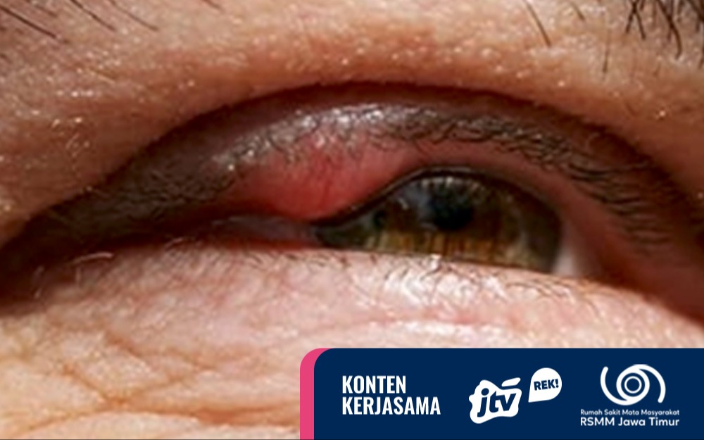 Benjolan Pada Kelopak Mata, Berbahayakah? - Portal JTV